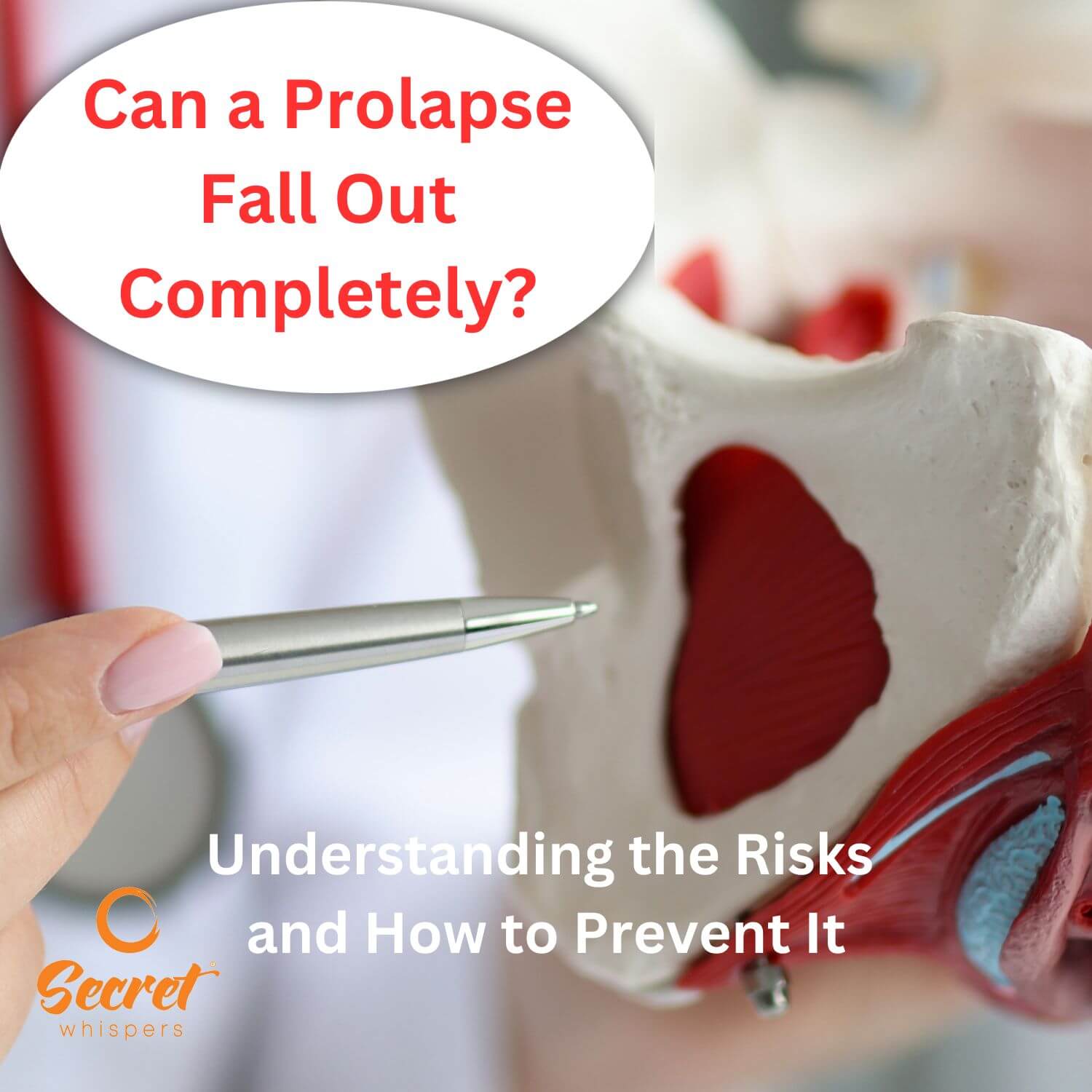 Can a Prolapse Fall Out Completely? Learn How to Prevent It